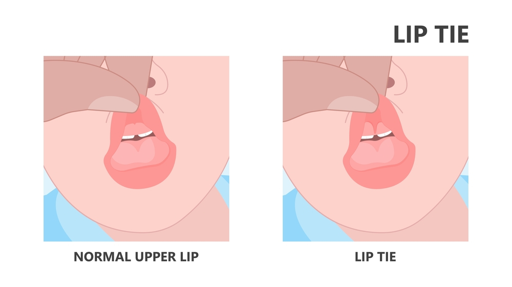 Frenectomy Procedure in Goodyear Arizona | TongueTiePhoenix