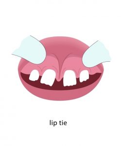Lip Tie Vs Normal Frenulum - Major Differences Explained!