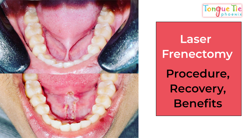 Laser Frenectomy: Procedure, Recovery, Benefits And All About It