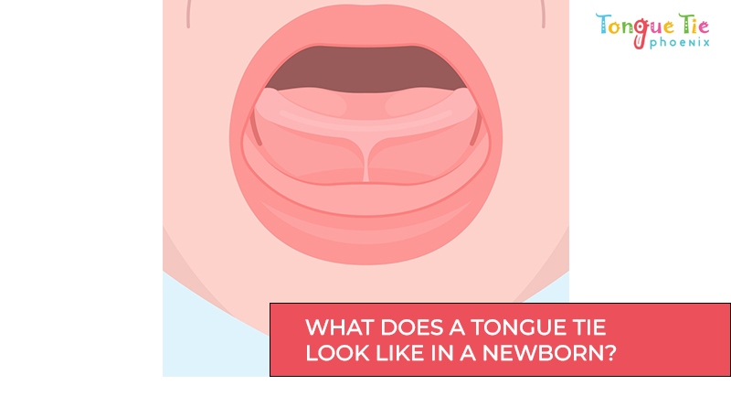 Lip Tie Grading: Understand and Treat All 4 Levels Effectively
